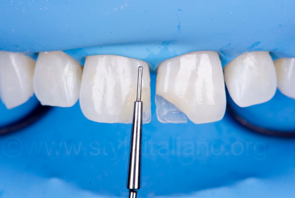 Composites - Future Dentist
