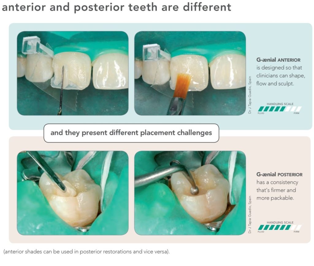 GC G-Aenial Anterior & Posterior - Future Dentist