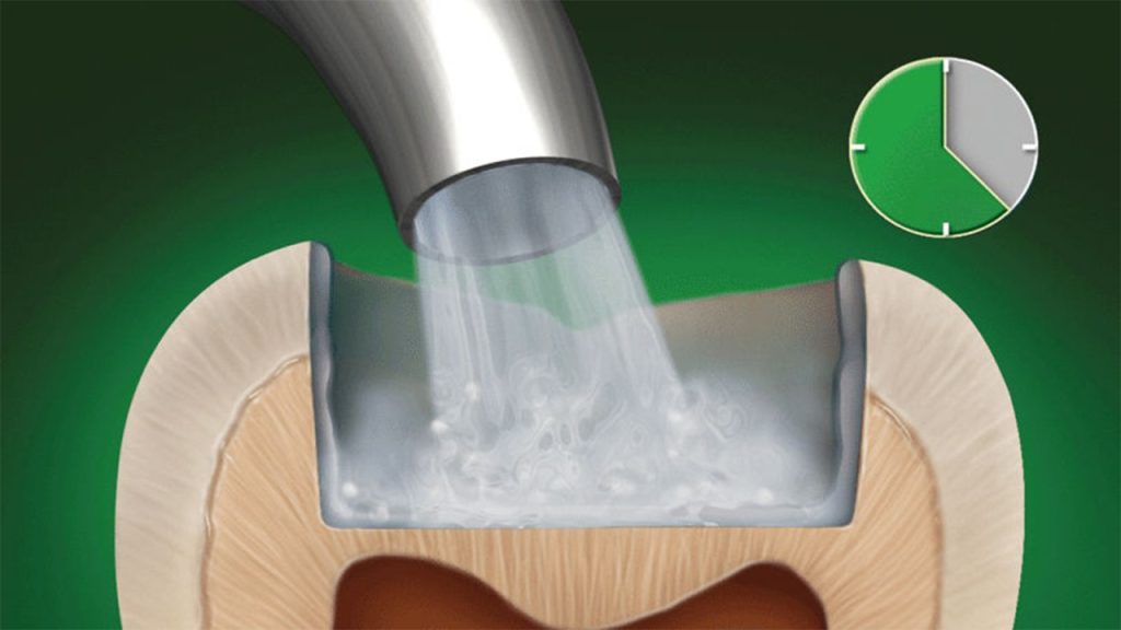 Kulzer Gluma Etch 35 Gel - Future Dentist